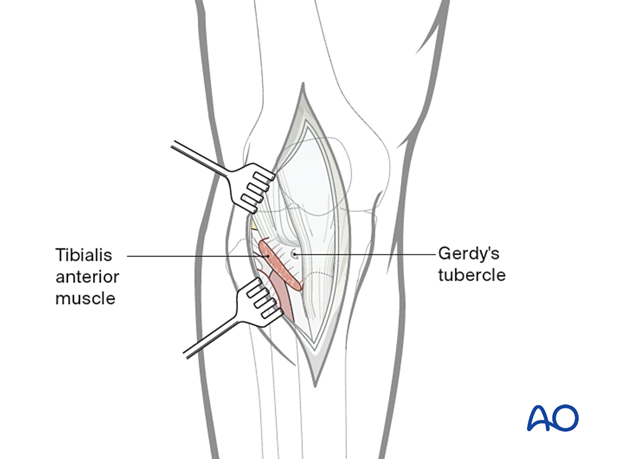 Gerdys Tubercle