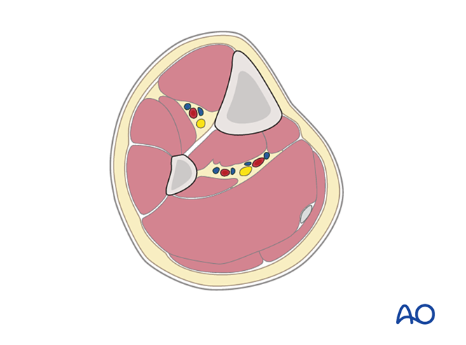 MIO Anterolateral approach to the proximal tibia