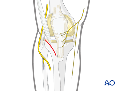 MIO Anterolateral approach to the proximal tibia