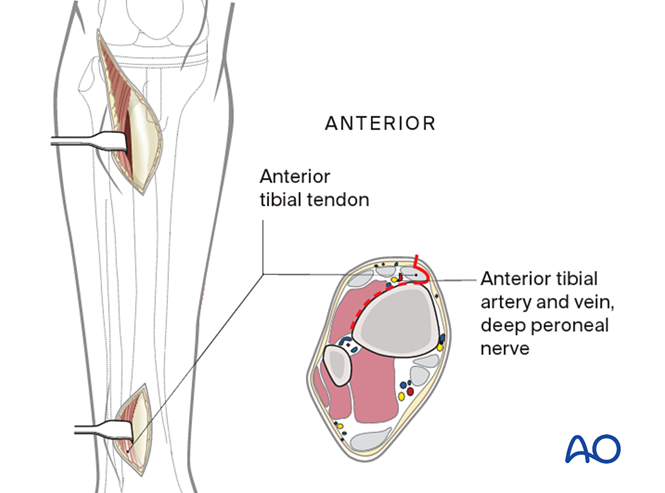 MIO Anterolateral approach to the proximal tibia