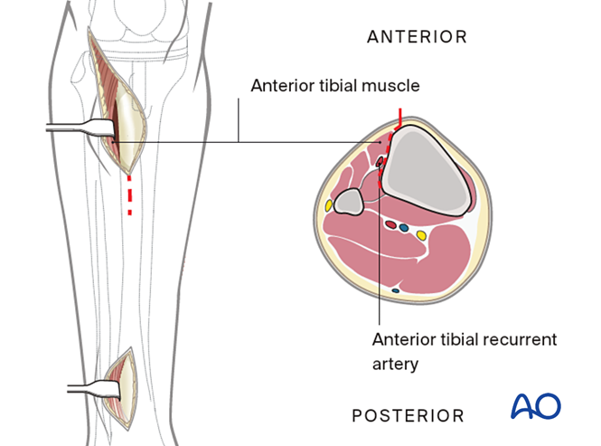 MIO Anterolateral approach to the proximal tibia