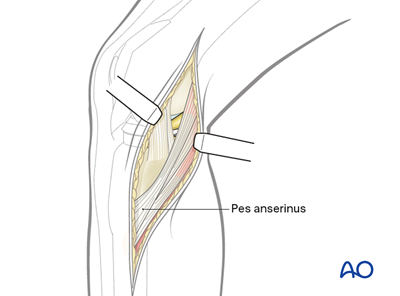 Medial approach to the proximal tibia