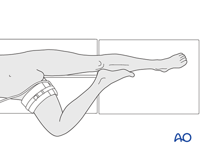 Medial approach to the proximal tibia