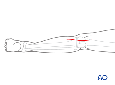 Posteromedial approach to the proximal tibia