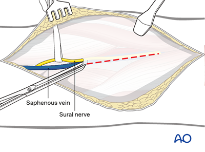 Posteromedial approach to the proximal tibia