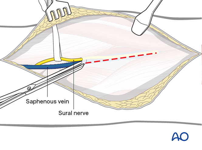 Posteromedial approach to the proximal tibia