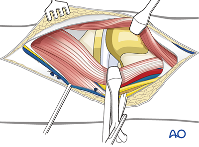 Posteromedial approach to the proximal tibia