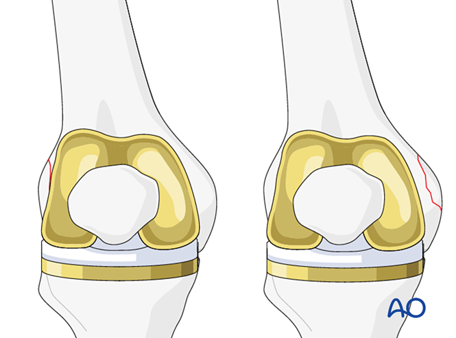 Lateral/medial femoral epicondyle fracture