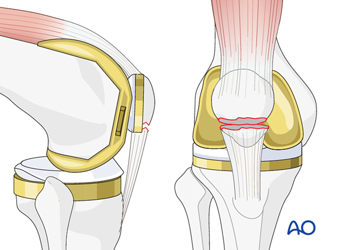 Disrupted extensor mechanism