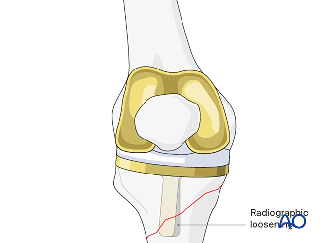 Fracture around a loose tibial component with good bone stock