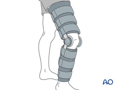 Immobilization for Nondisplaced tibial plateau or tubercle fracture