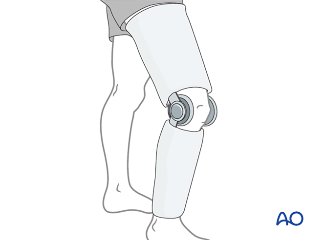 Immobilization for Nondisplaced tibial plateau or tubercle fracture