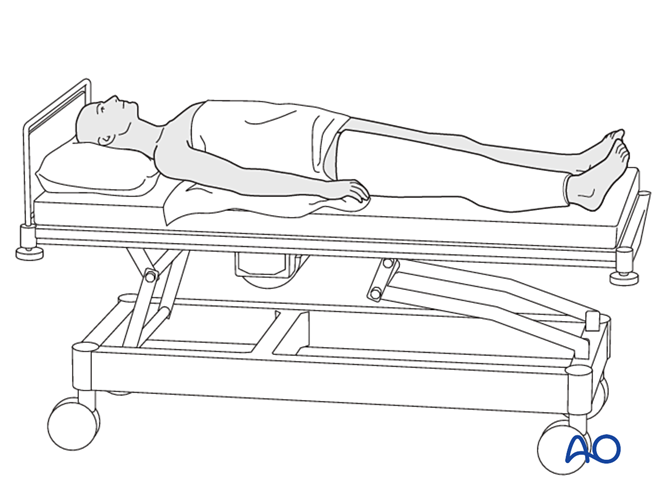 Long leg cast for Fracture around a loose femoral component with poor ...