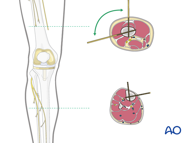 Temporary external fixator for Fracture around a stable femoral ...