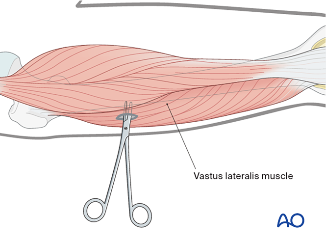 Temporary external fixator for Fracture around a stable femoral ...