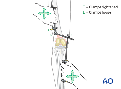 Temporary external fixator for Fracture around a stable femoral ...