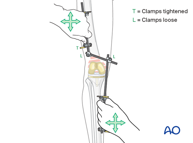 Temporary external fixator for Fracture around a stable femoral ...