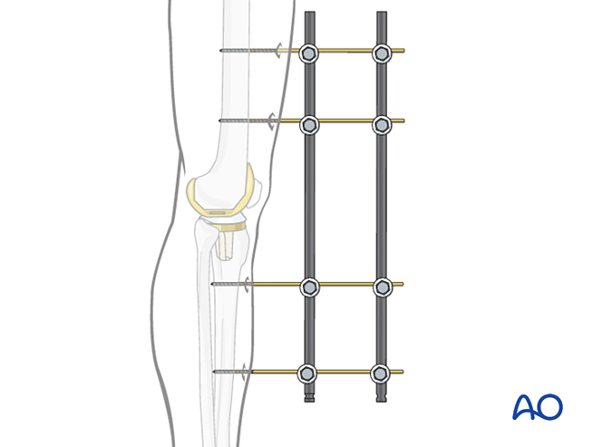 Temporary external fixator for Fracture around a stable femoral ...