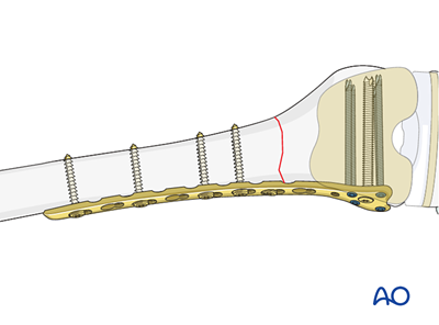 Compression plate for Fracture around a stable femoral component with ...