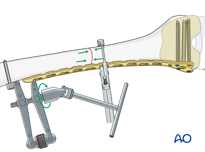 Compression plate for Fracture proximal to the femoral component