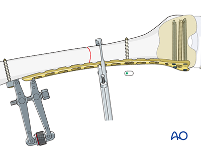 Compression plate for Fracture proximal to the femoral component
