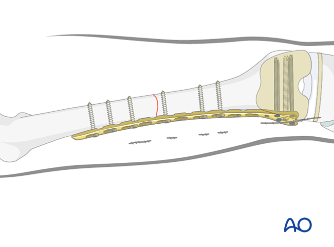 Compression plate for Fracture proximal to the femoral component