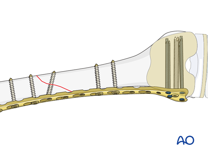 Compression plate for Fracture proximal to the femoral component