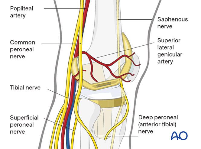 Lateral/anterolateral approach to the distal femur