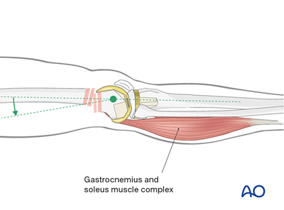 Retrograde nailing for Fracture proximal to the femoral component