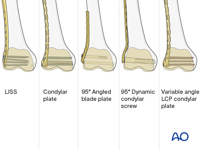 Bridge plate for Fracture proximal to the femoral component