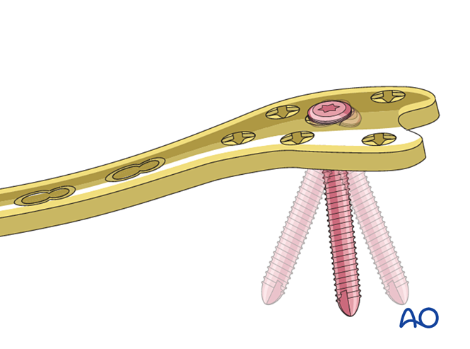 Compression plate for Fracture around a stable femoral component with ...