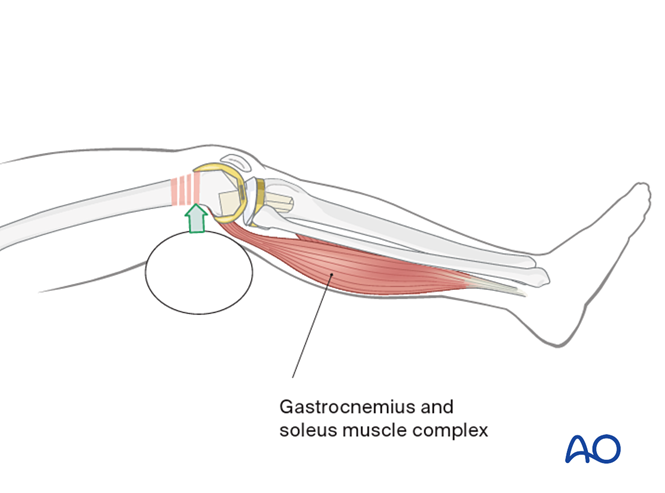 Retrograde nailing for Fracture proximal to the femoral component
