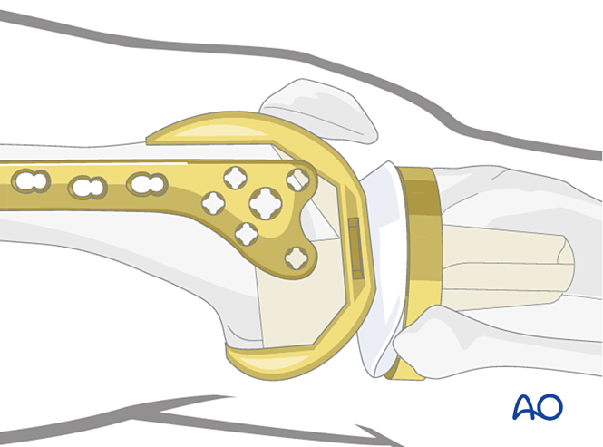 Bridge plate for Fracture around a stable femoral component with good ...
