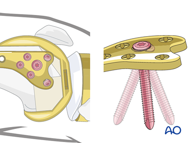 Bridge plate for Fracture proximal to the femoral component
