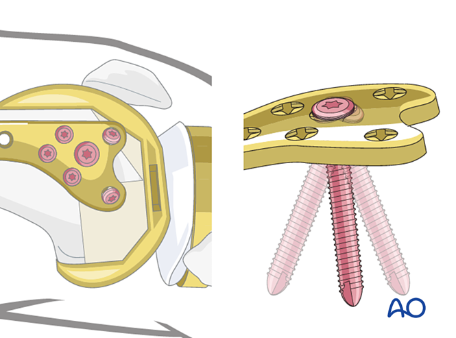 Bridge plate for Fracture proximal to the femoral component