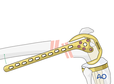 Bridge plate for Fracture around a stable femoral component with good ...