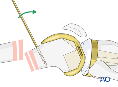 Bridge plate for Fracture proximal to the femoral component