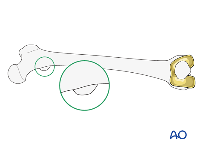 Bridge plate for Fracture proximal to the femoral component