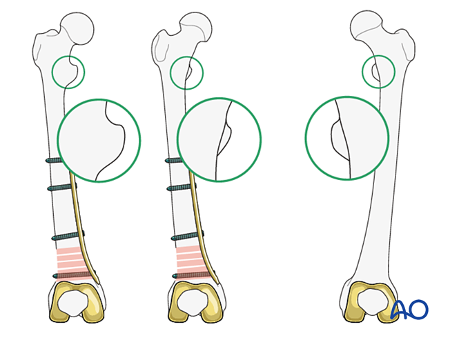 Bridge plate for Fracture around a stable femoral component with good ...