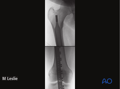 Distal femoral replacement for Fracture around a loose femoral ...