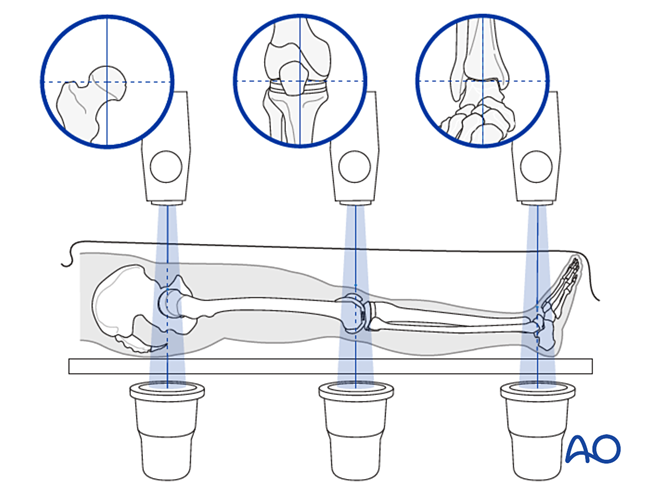 Retrograde nailing for Fracture proximal to the femoral component