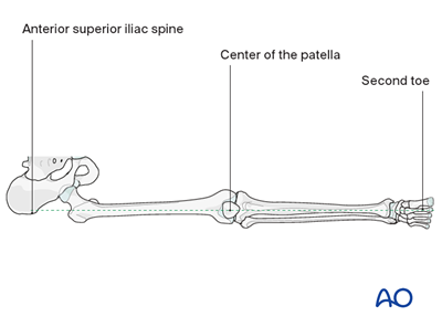 Bridge plate for Fracture proximal to the femoral component