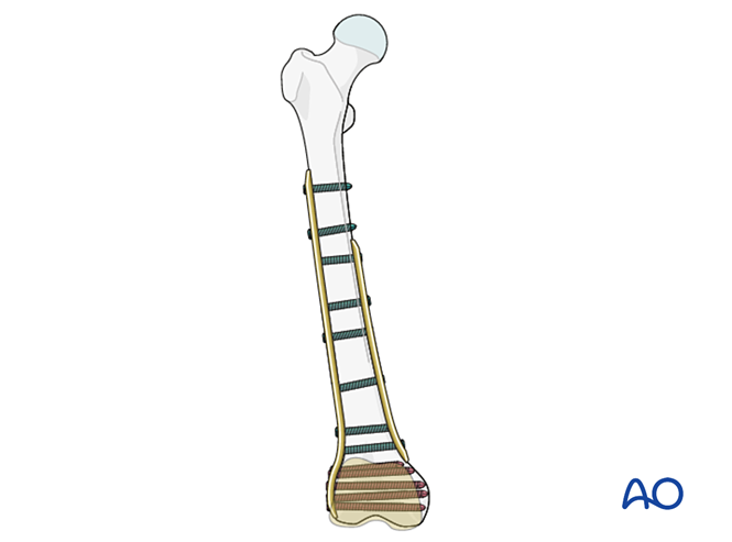 Bridge plate for Fracture proximal to the femoral component