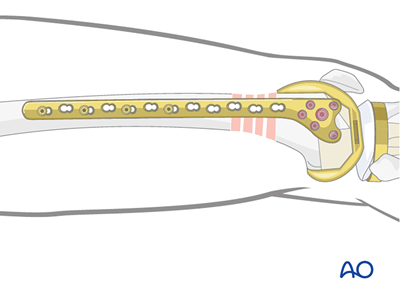 Bridge plate for Fracture around a stable femoral component with good ...