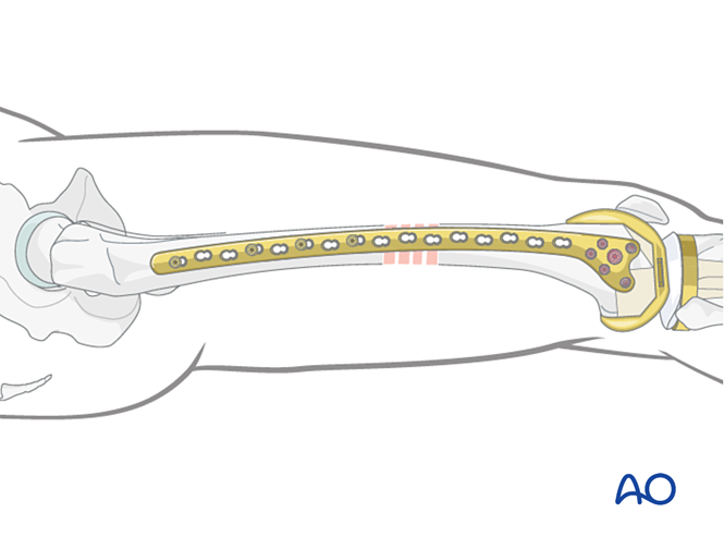 Bridge plate for Fracture proximal to the femoral component