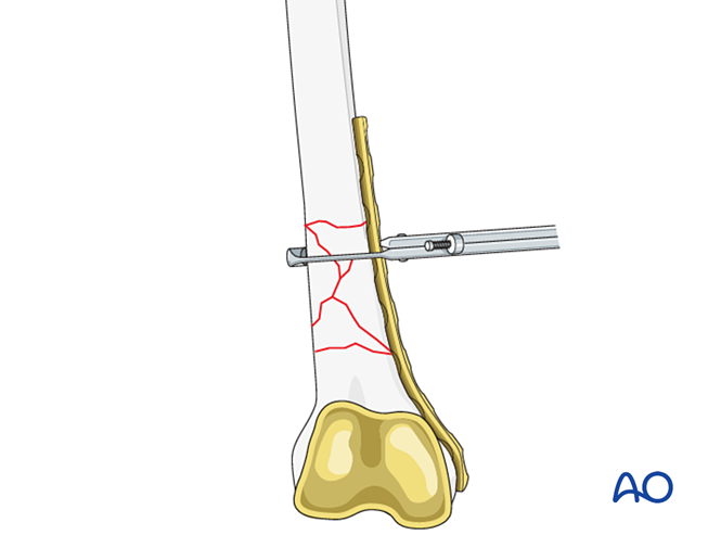 Double plate for Fracture proximal to the femoral component