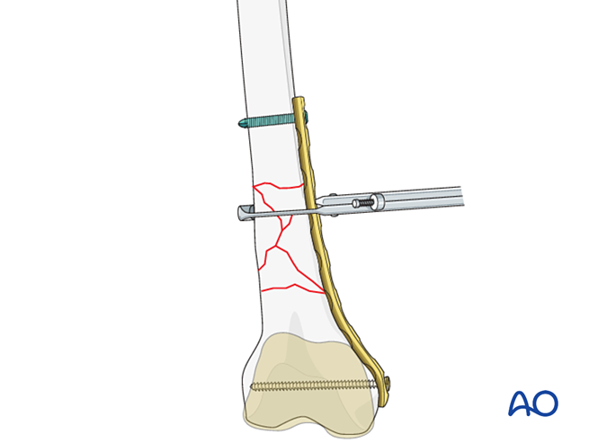 Double plate for Fracture proximal to the femoral component