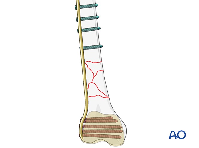 Double plate for Fracture proximal to the femoral component