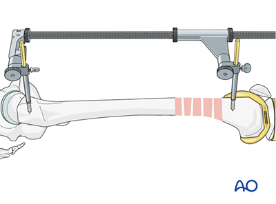 Retrograde nailing for Fracture proximal to the femoral component