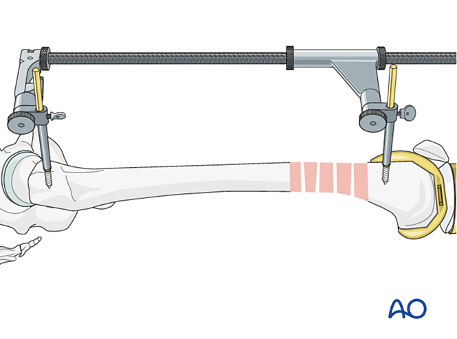 Retrograde nailing for Fracture proximal to the femoral component